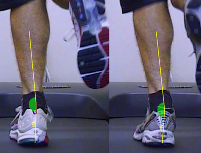 Foot Pronation: is the term 'Overpronation' valid?